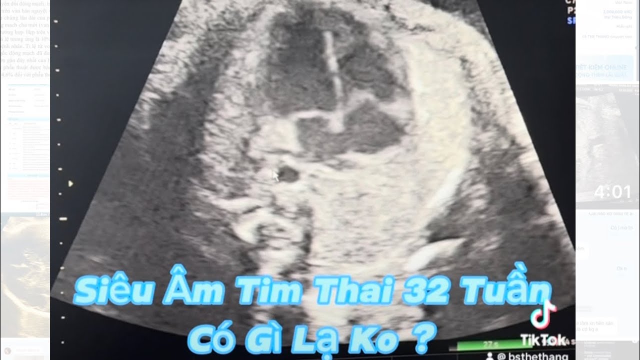 Siêu Âm Tim Thai 32 Tuần - Có Gì Lạ ? - YouTube