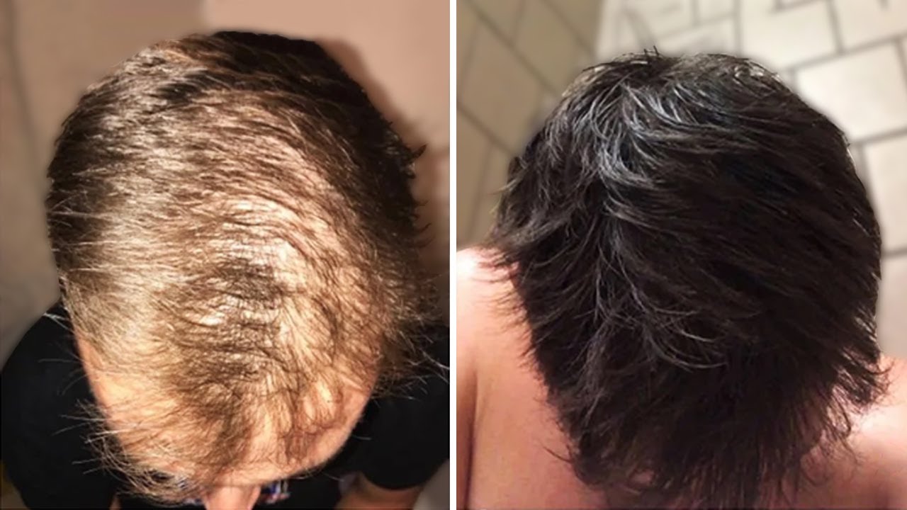 Su Pelo Vuelve De La Tumba En 4 Meses - YouTube