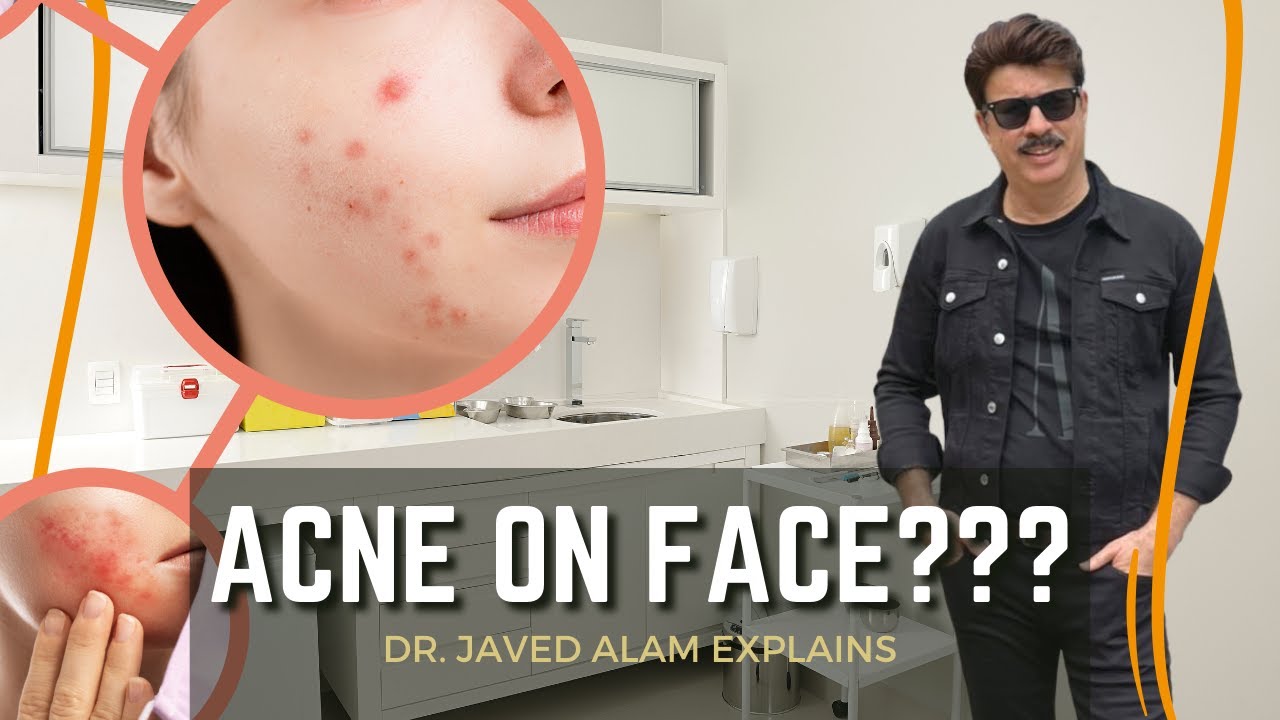 How Can Acne Be Cured? | How Acne Affects our Social Lives | Dr. Javed ...