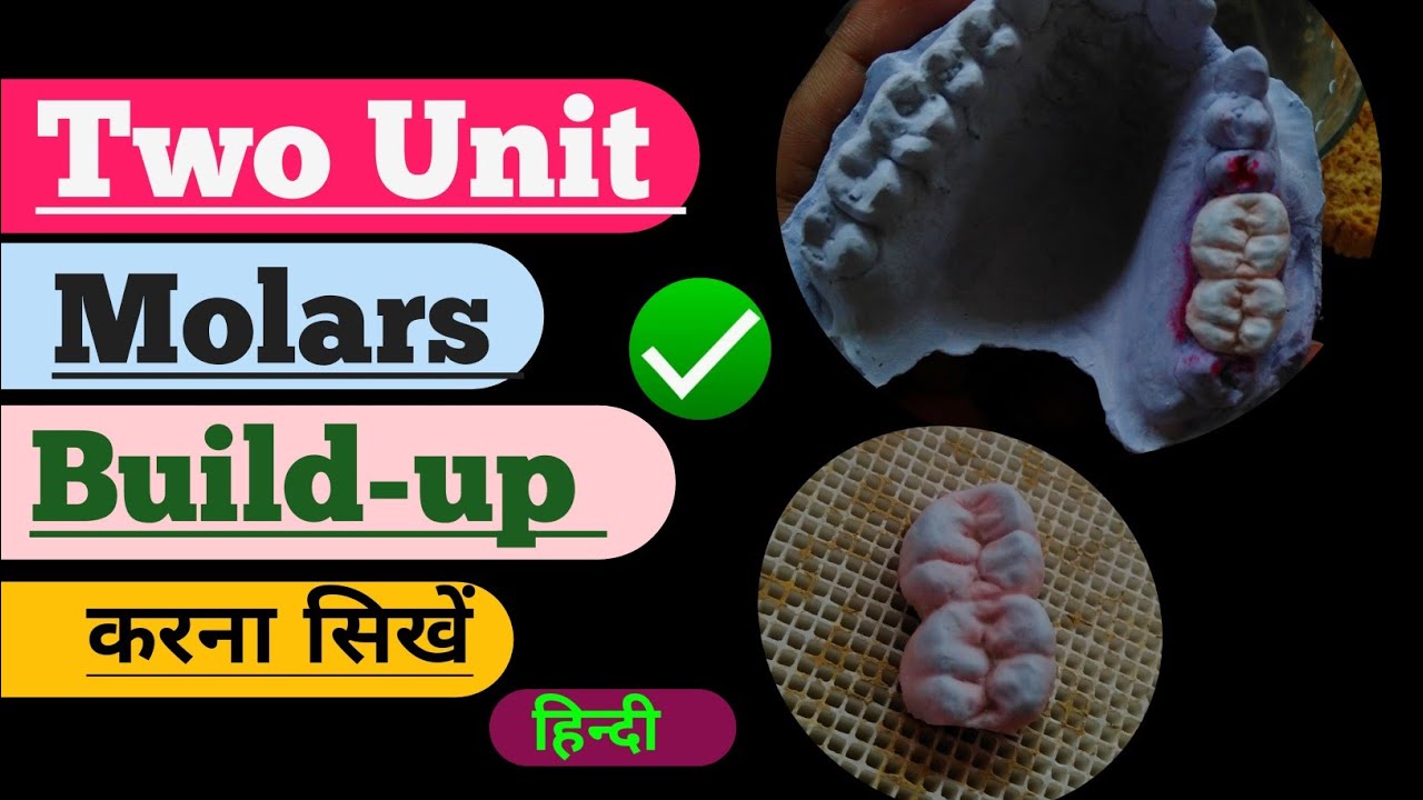Two Unit Molars Build-up | Laboratory | Ceramics | Porcelain | Build up ...