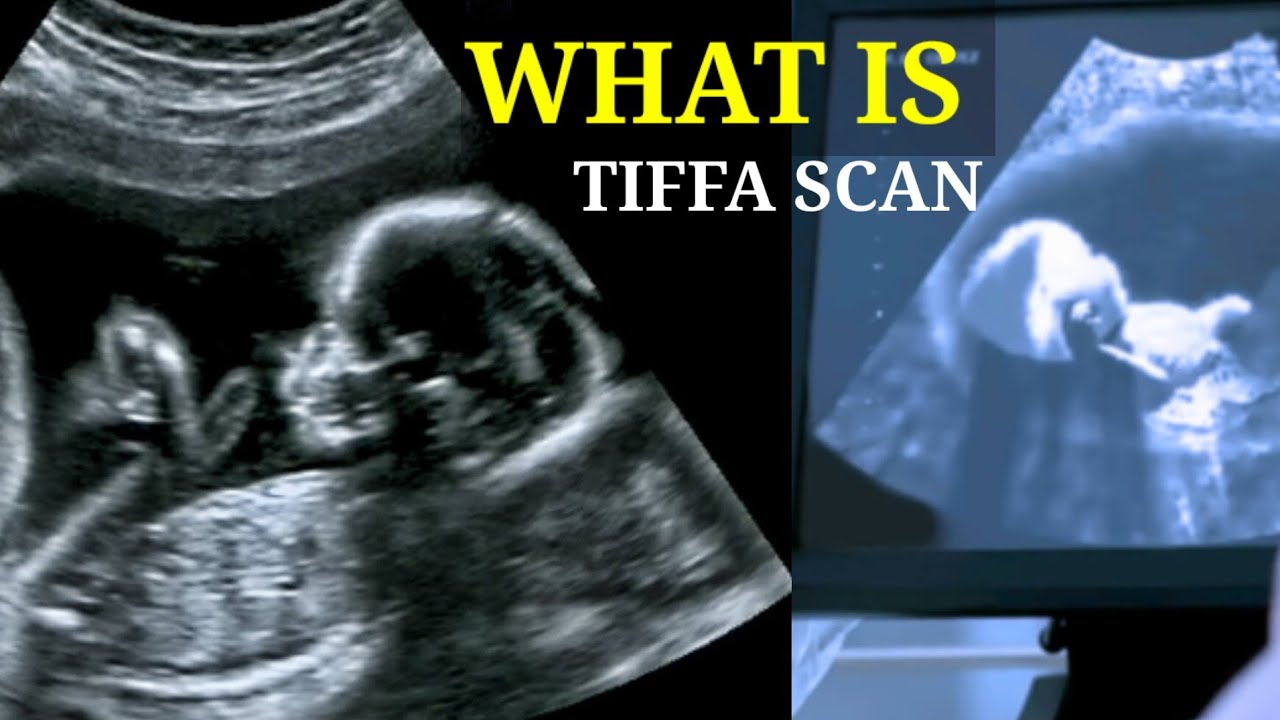 What is Tiffa || ultrasound || level 2 scan || Dr. Indu Yadav || # ...