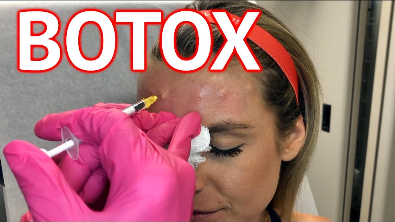 I GOT BOTOX : Before & After Pictures - YouTube