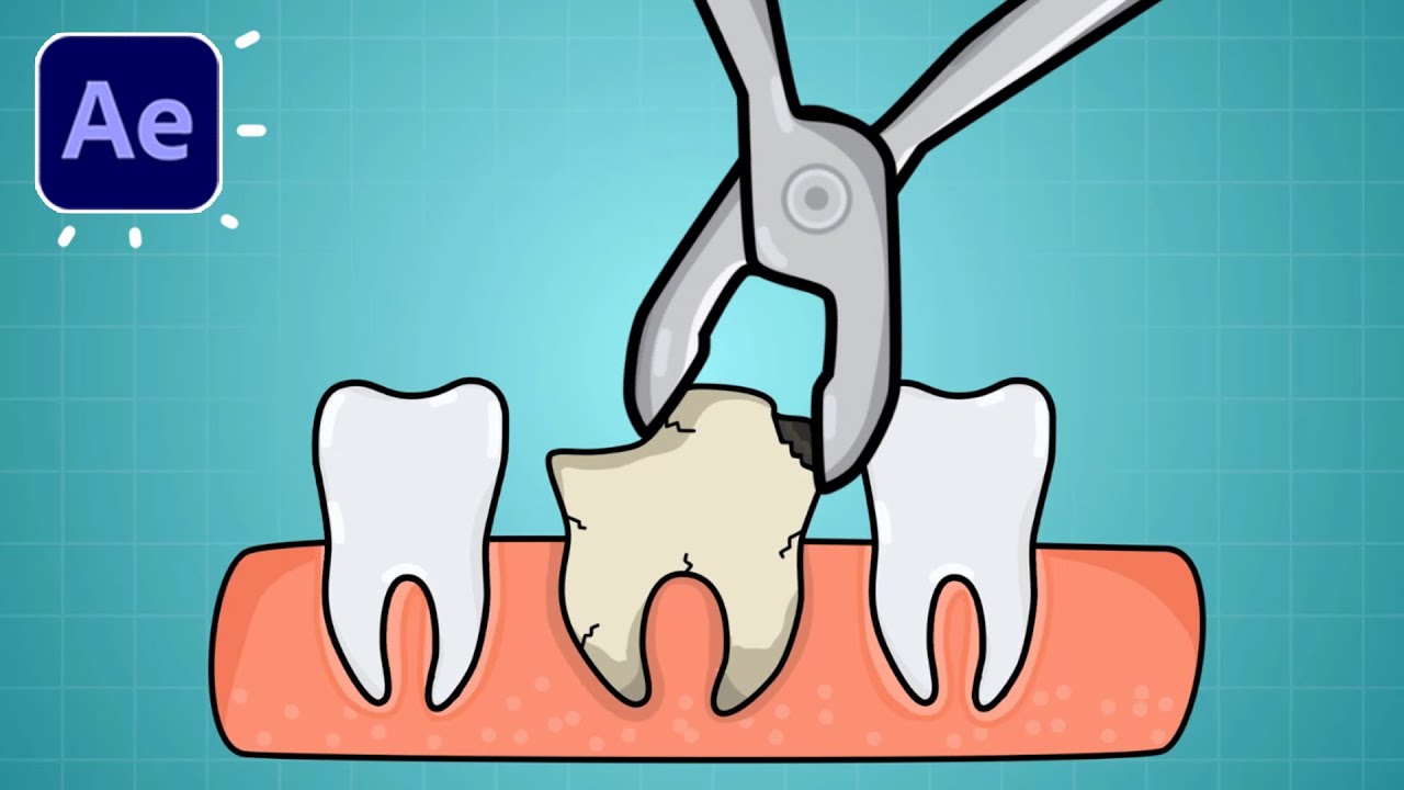 Tooth Extraction Medical Animation in After Effects Tutorials - YouTube