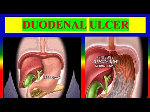 DUODENAL ULCERS - Define, etiology, clinical, complications , treatment ...