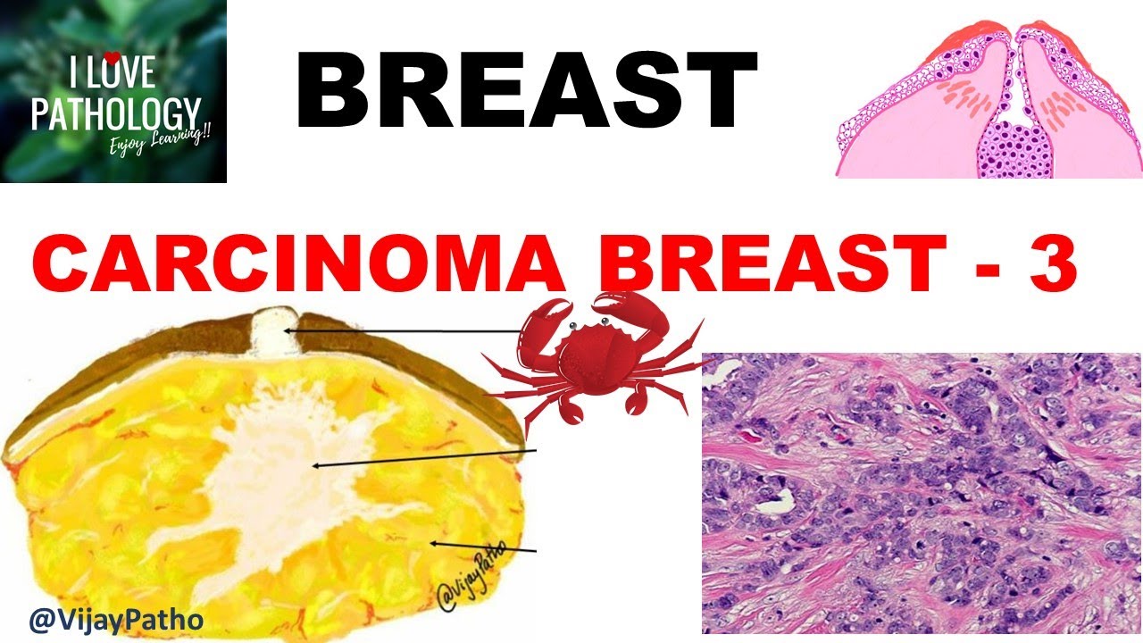 Diseases of Breast: Part 6: Breast carcinoma- Invasive:Types ...
