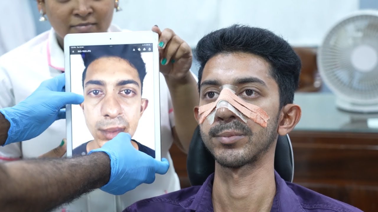 External Nasal splint removal after Surgery - Repeat Nose Job Results ...