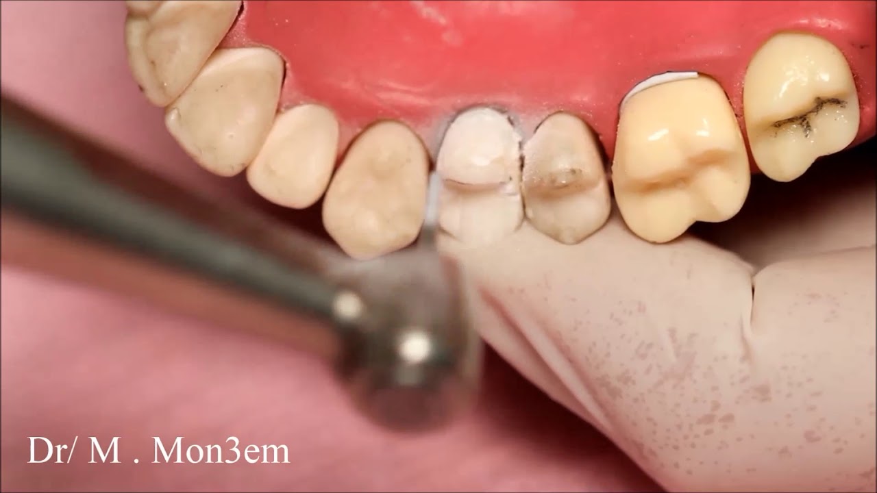 veneered metal ceramic crown preparation - YouTube