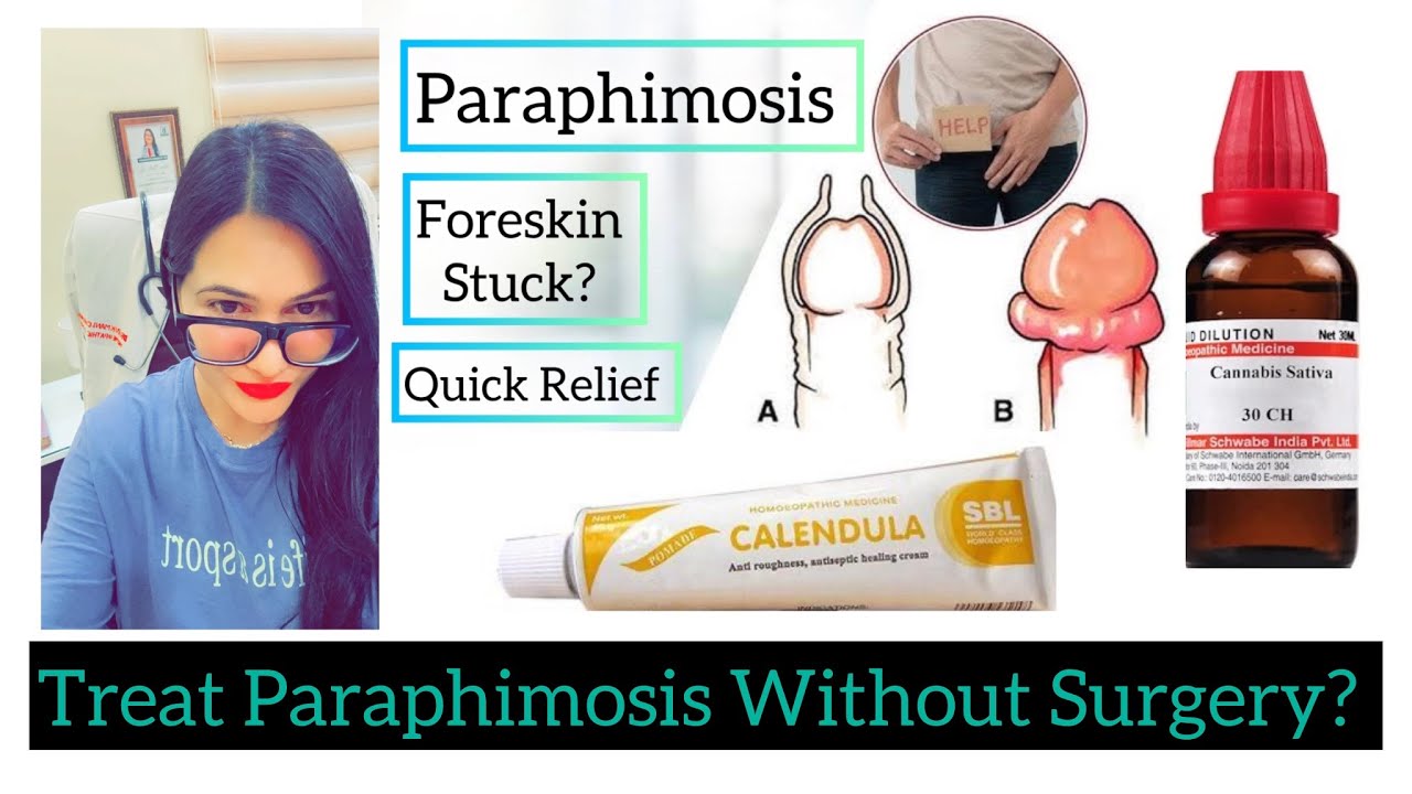 Foreskin Stuck ? Paraphimosis Best Homeopathic Medicine? Foreskin ...