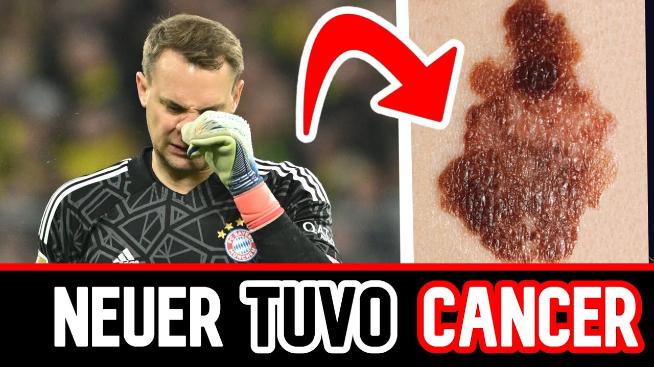 La Lucha de Manuel Neuer: Venciendo al Cáncer y Volviendo a Dominar el ...