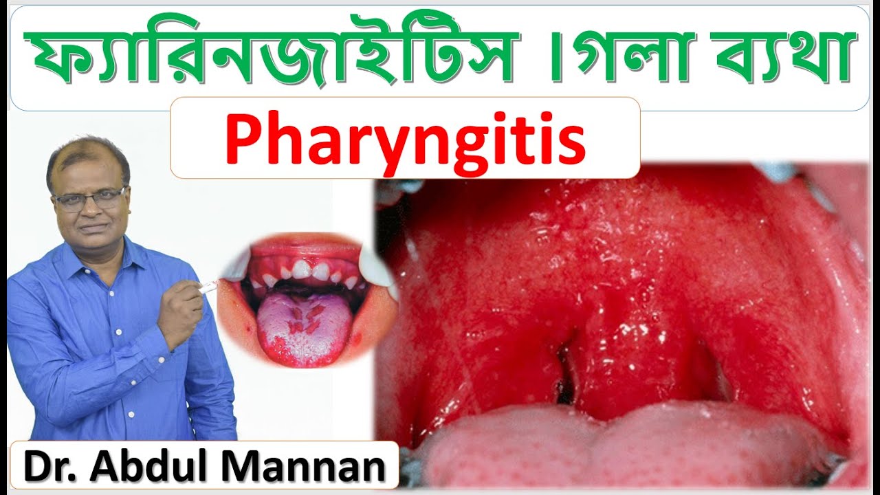 Pharyngitis । ফ্যারিনজাইটিস । গলা ব্যথা । হোমিওপ্যাথিক চিকিৎসা। Dr Abdul Mannan - YouTube