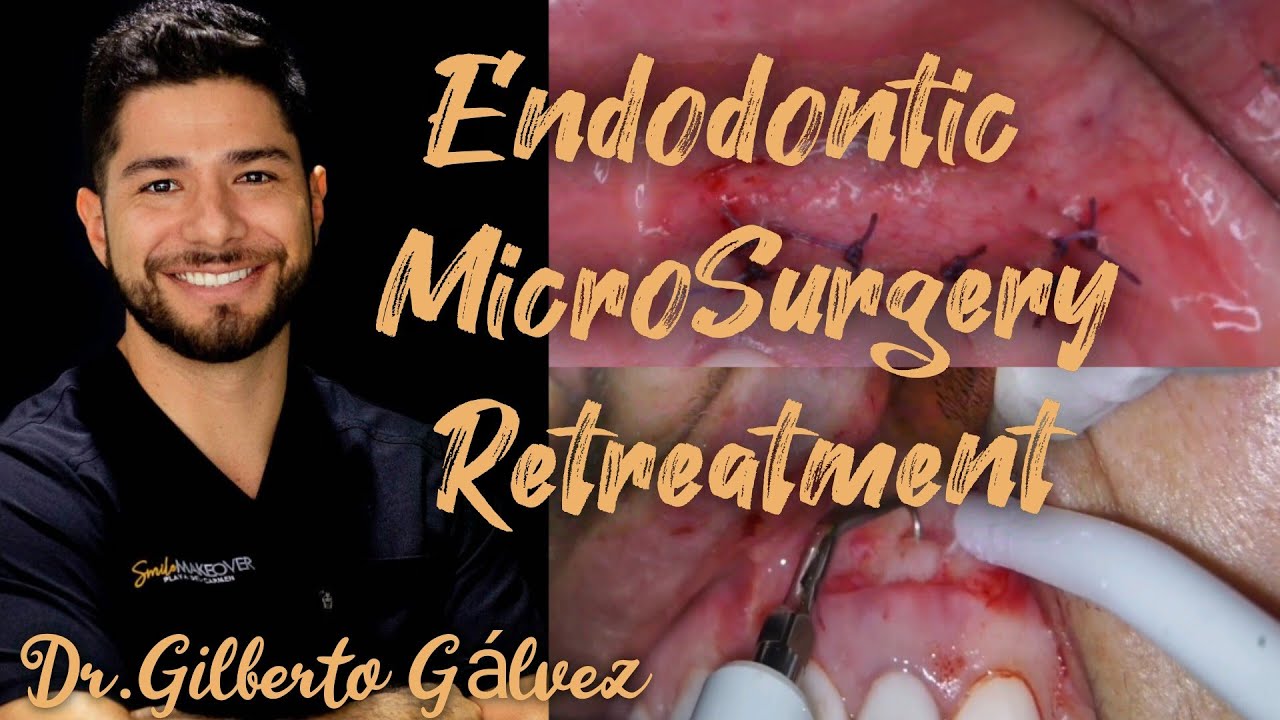 Endodontic Microsurgery Retreatment . Root canal retreatment. Dr ...