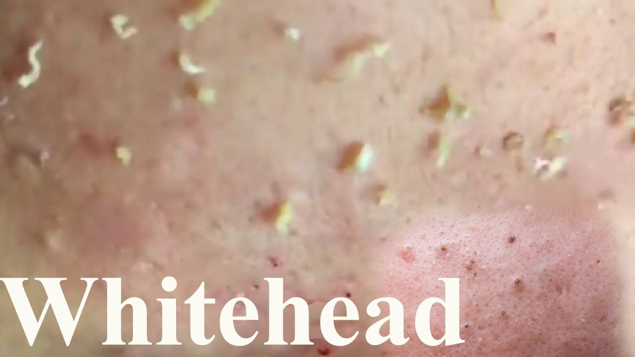 Whiteheads Treatment & Removal || Satisfying Videos Face Skin care ...
