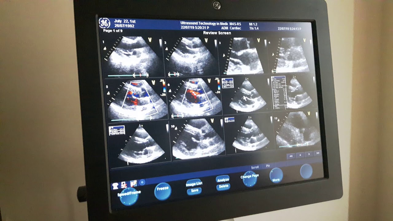 Understanding PLAX Views In ECHOCARDIOGRAPHY - YouTube