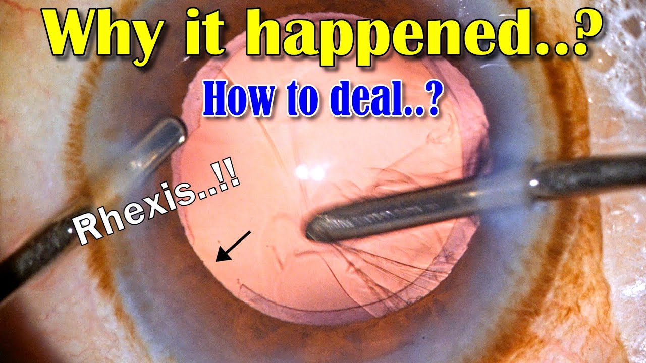 Unusual Rhexis Complication -Phacoemulsification :- Dr Deepak Megur ...