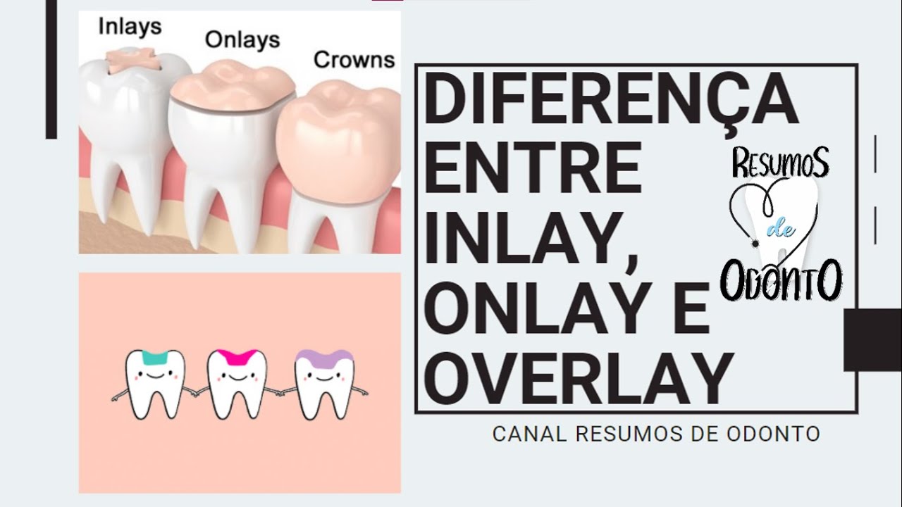 Explicando sobre inlay, onlay e overlay | Resumos de Odonto - YouTube