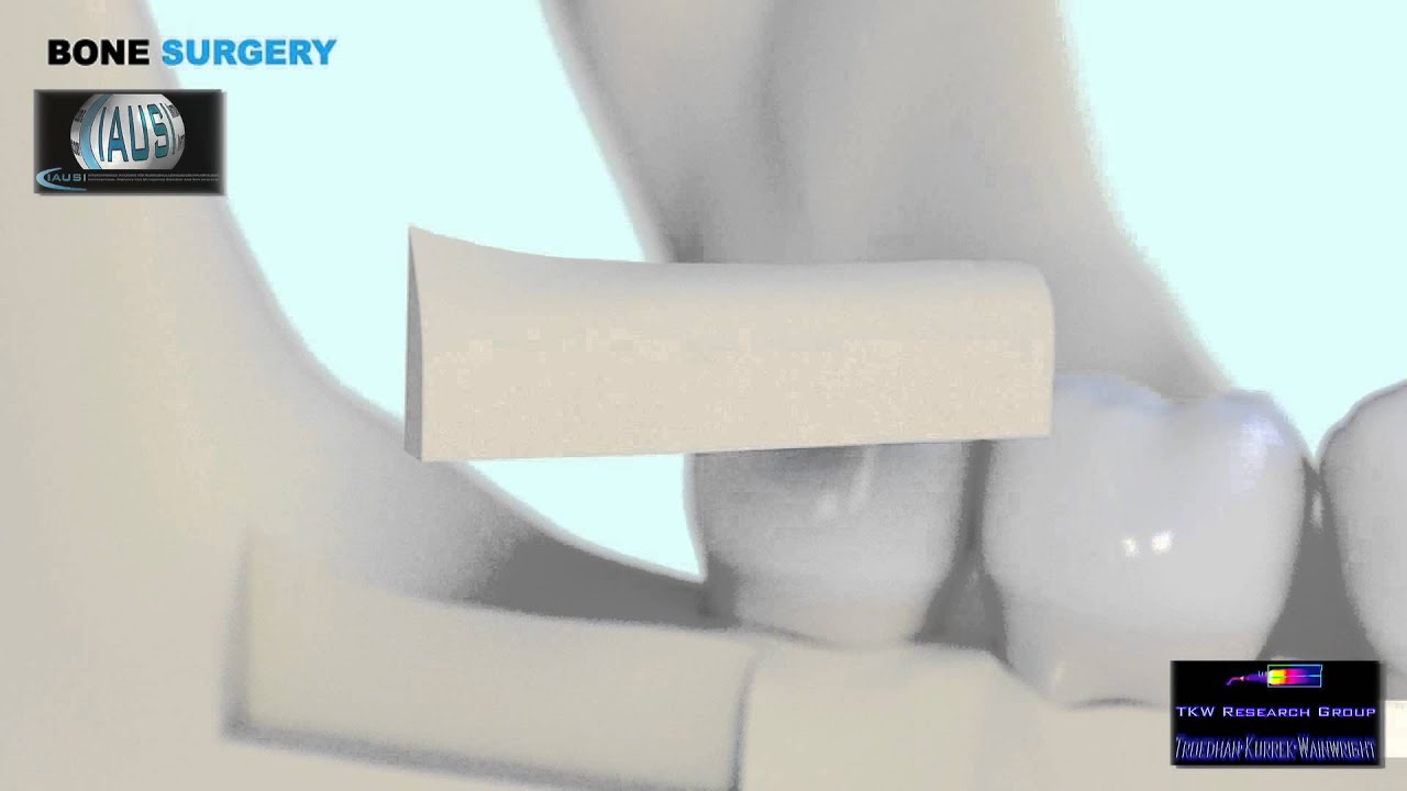 BONE SURGERY BONE GRAFT PROTOCOL ANIMATION - YouTube