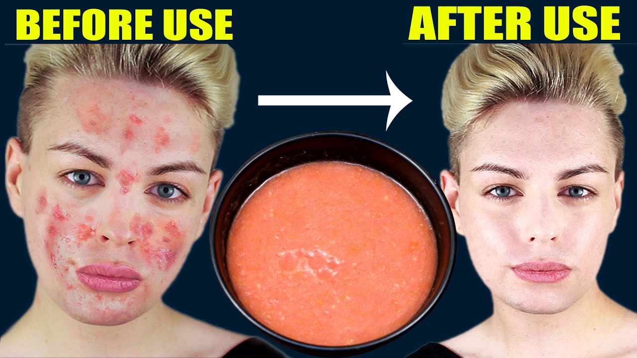 Tomato Face Mask to Get Rid of Pores | Tomato Face Scrub for Glowing ...