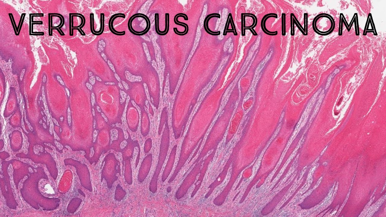 Verrucous carcinoma (it's NOT caused by HPV) pathology dermpath ...