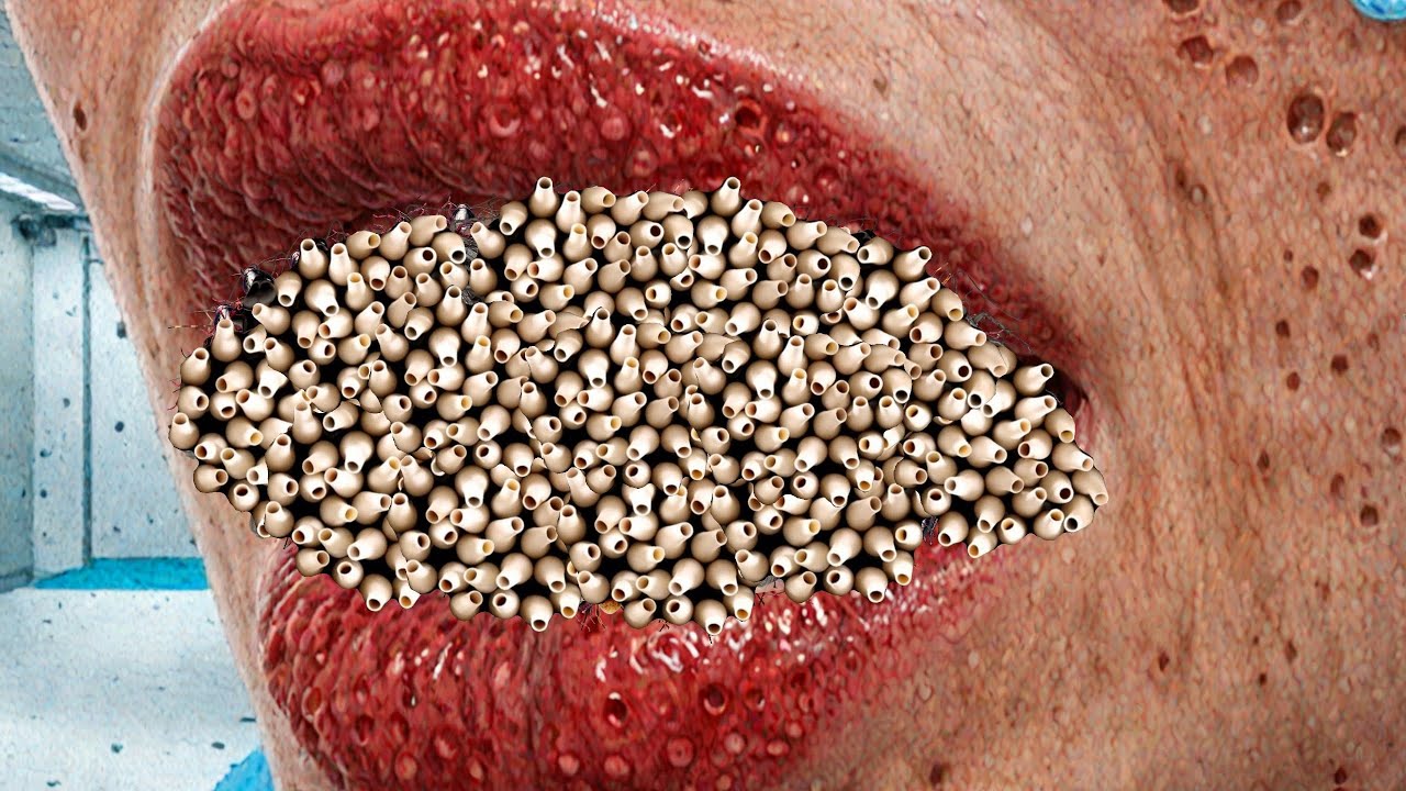 ASMR Maggots Infected Inside Mouth | ASMR Mouth Treatment Animation ...