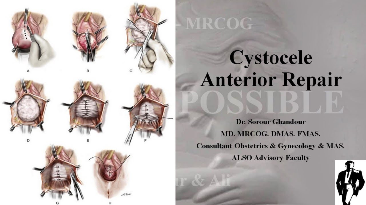 Cystocele Anterior Rapair Anterior Colporraphy Mrcog Part 2 And 3 Tasks Youtube
