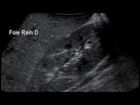 Echographie du tube digestif Pr BENAZZOUZ Mustapha 17 02 2021 - YouTube