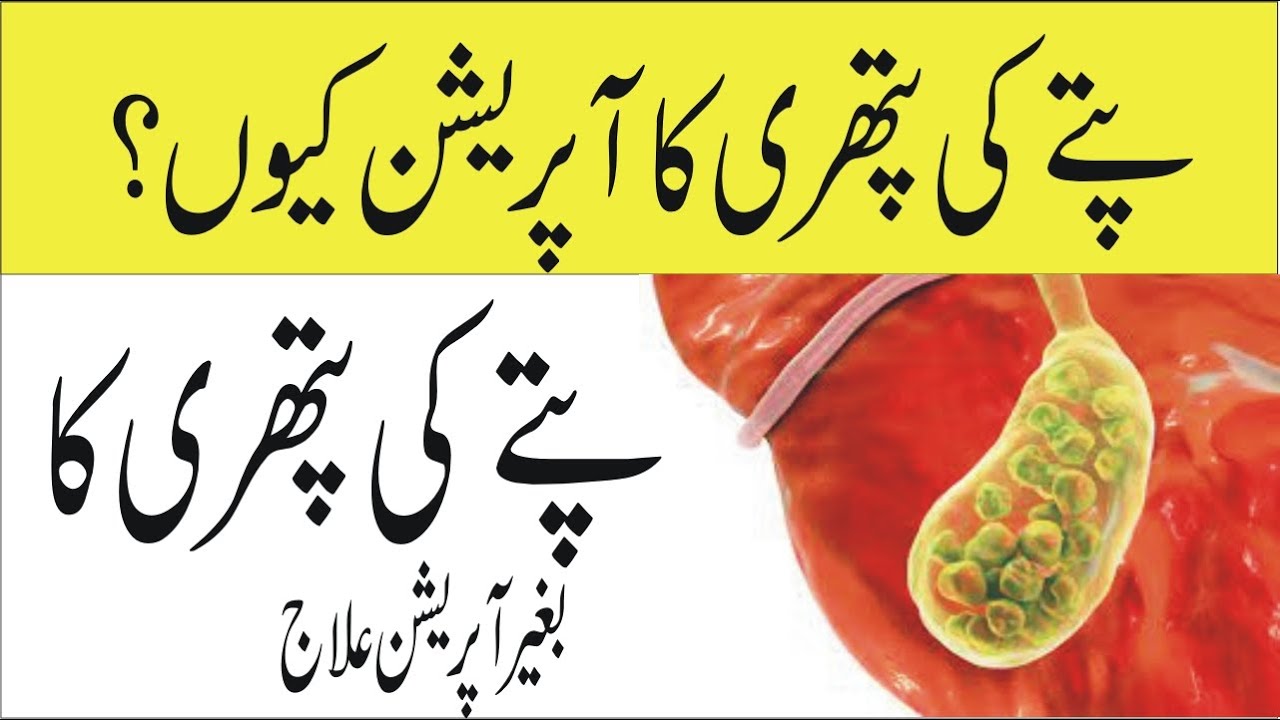 Gallstones Symptoms Treatment | Pitay Ki Pathri Ka Ilaj | Gallstones ...