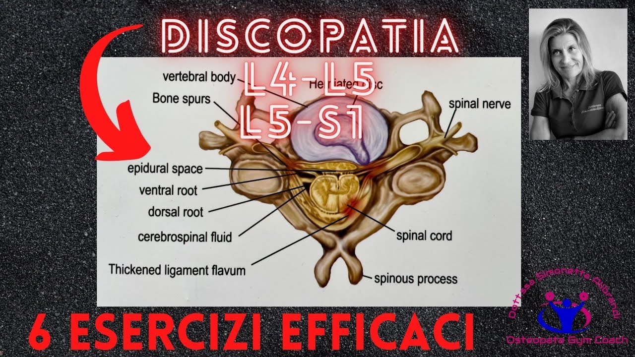 DISCOPATIA LOMBARE L4-L5/L5-S1 : 6 ESERCIZI EFFICACI - YouTube