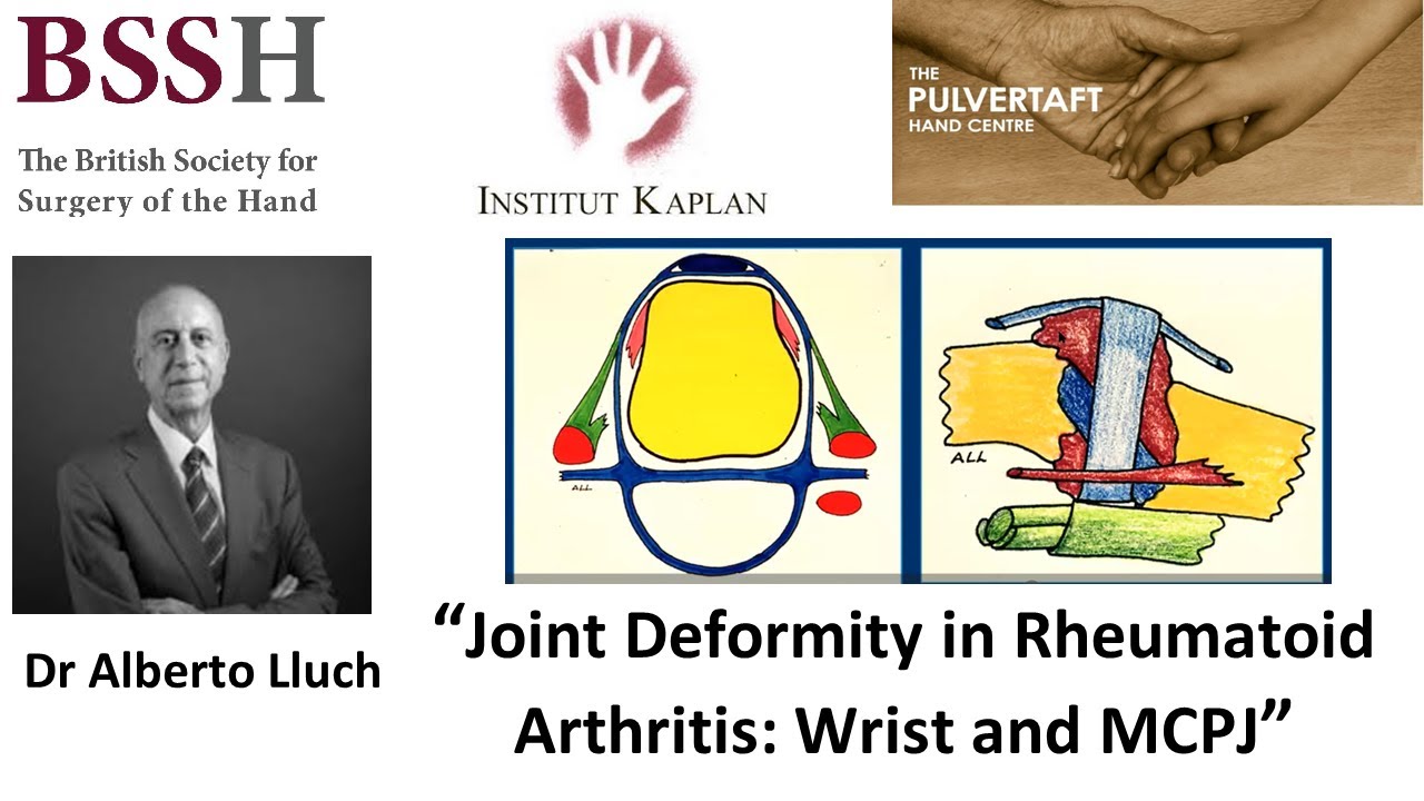 Joint deformity in rheumatoid arthritis wrist and MCPJ 2nd Ed by ...