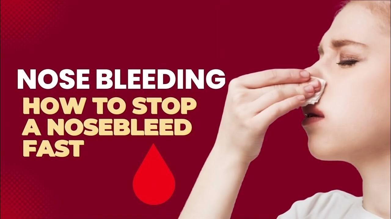 How to Stop a Nosebleed Fast: Simple Tips & Tricks - YouTube