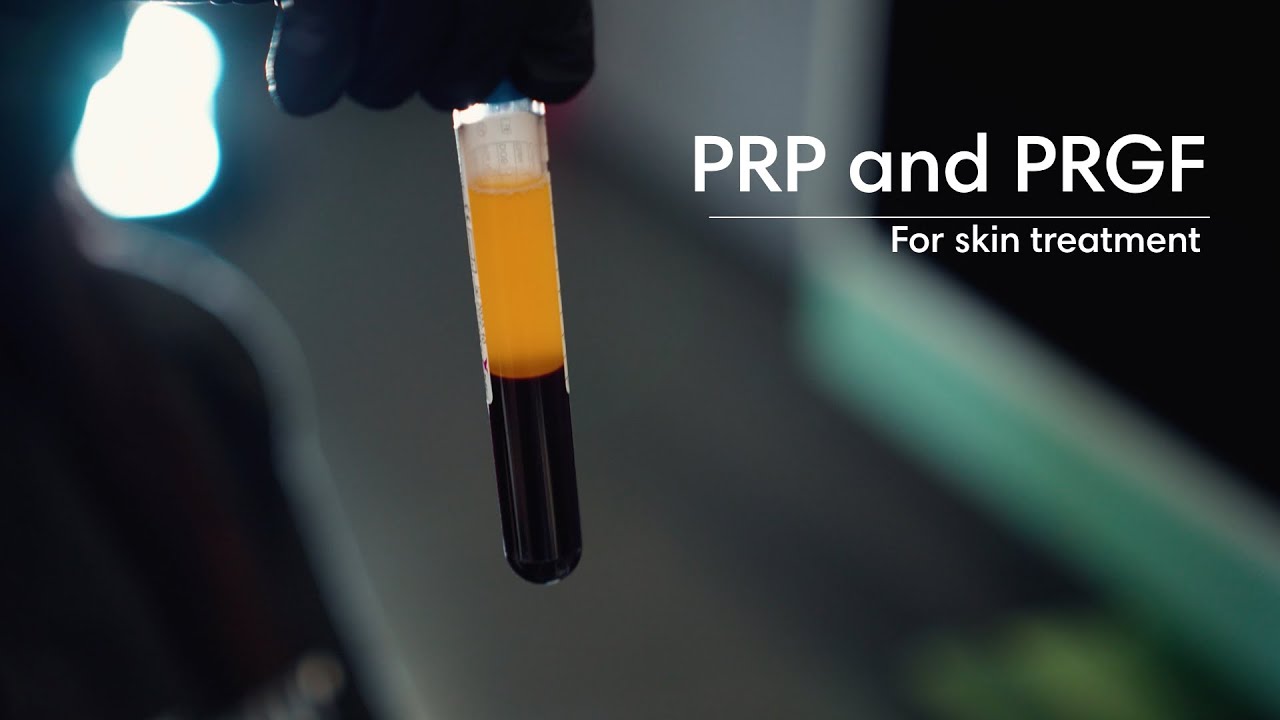 Platelet-Rich Plasma (PRP) and (PRGF) treatment for skin - YouTube