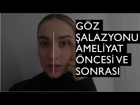 GÖZ ŞALAZYONU AMELİYAT ÖNCESİ VE SONRASI
