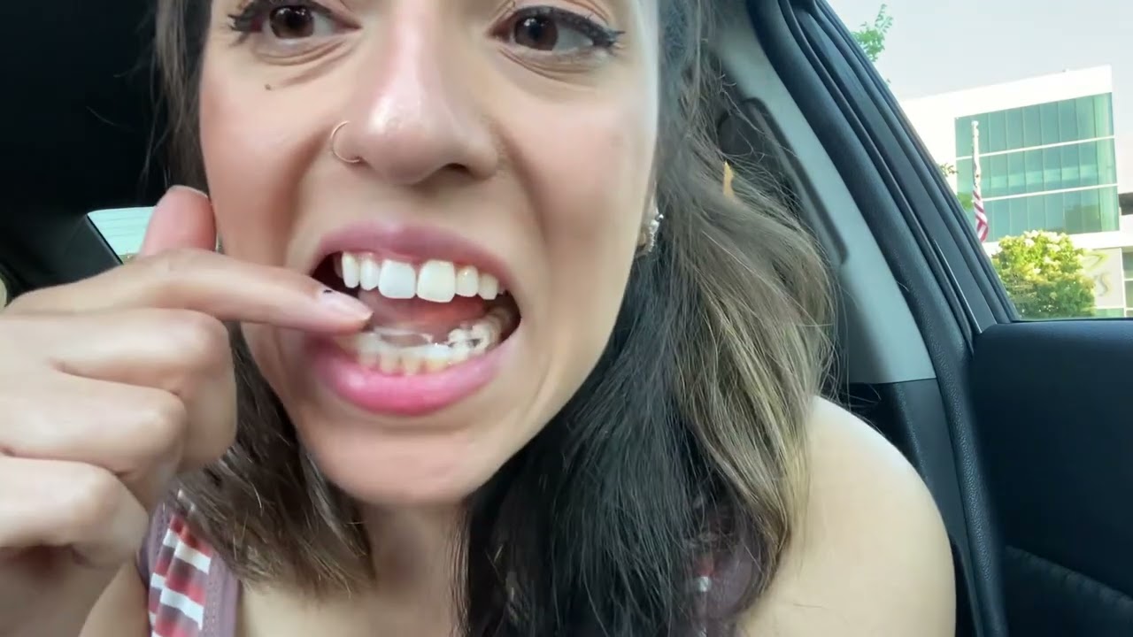 TMJ Orthotic Splint Therapy 6 month update HALFWAY THERE - YouTube