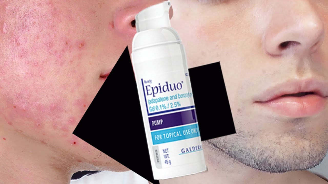 COMO CURE MI ACNE CON PEROXIDO DE BENZOLIO Y ADAPALENO (Epiduo) 100% ...