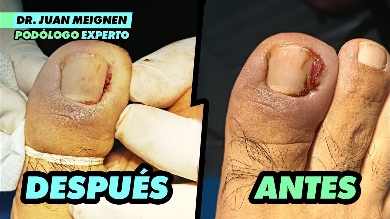 Uña Encarnada con Granuloma: Corrección Quirúrgica Precisa (Antes y ...