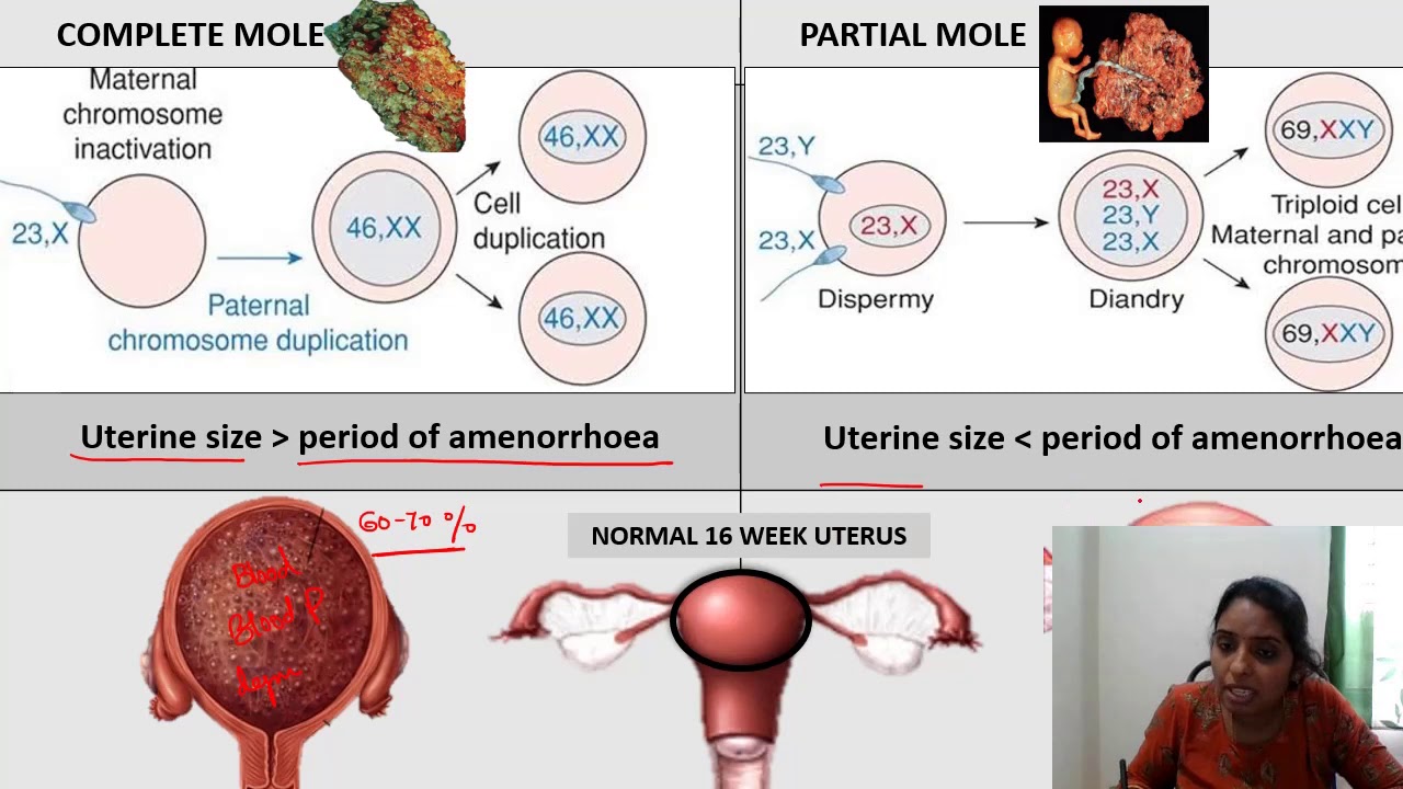 Hydatidiform mole - YouTube
