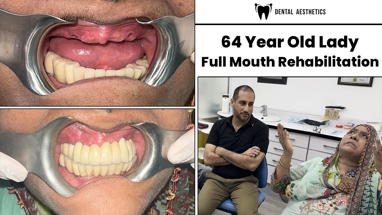 Full Mouth Rehabilitation For 64 Year Old Lady | Dental Implants Before ...