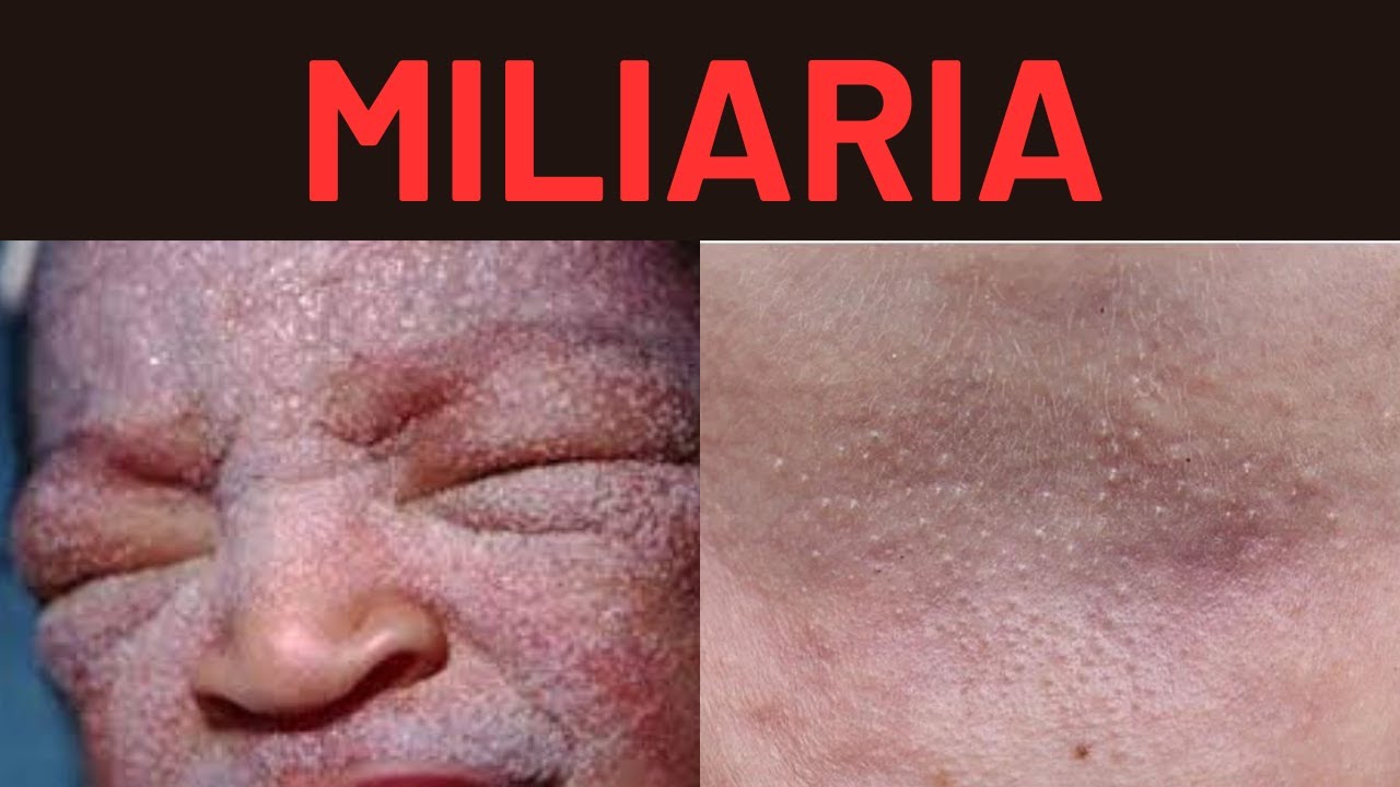 What is Heat Rash (Miliaria)? Causes, Treatment - YouTube
