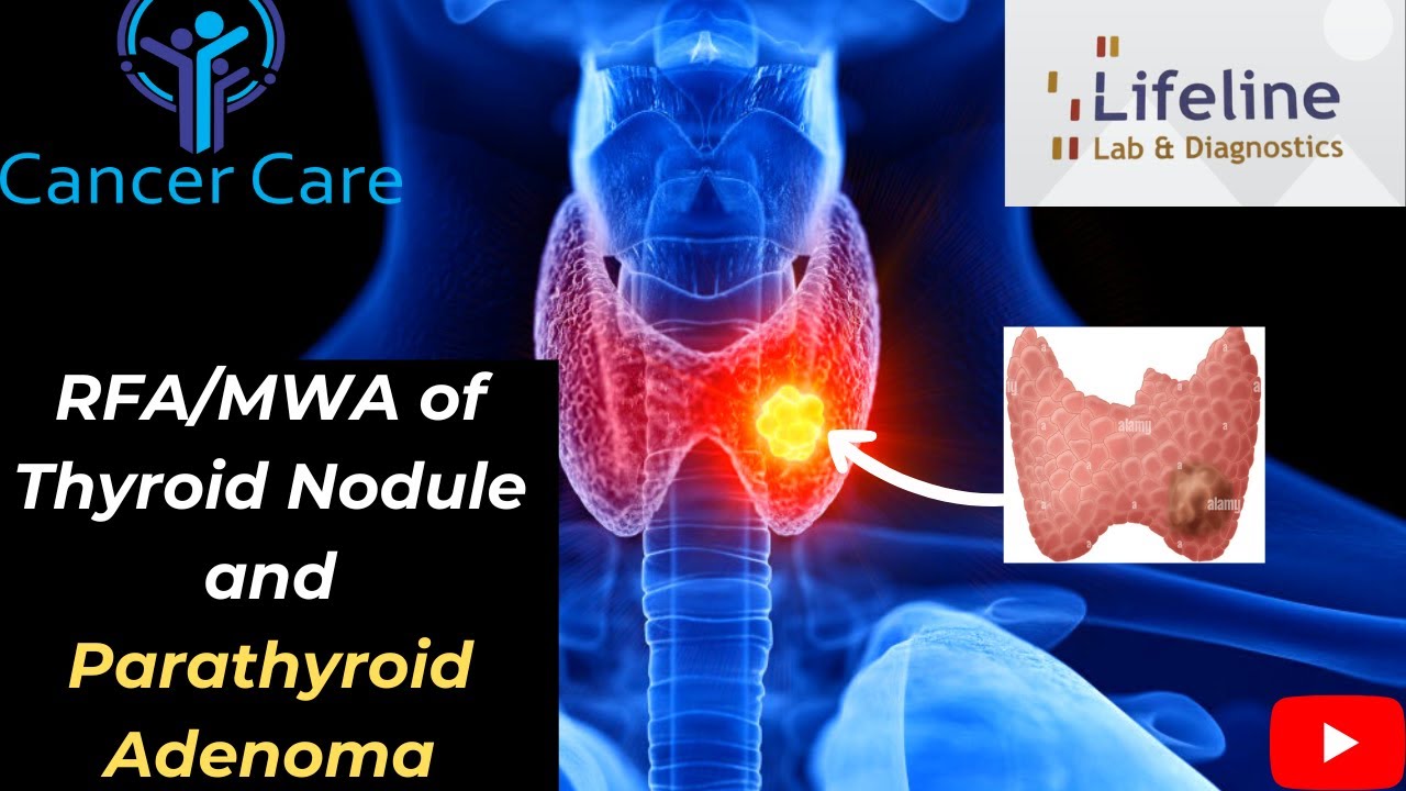 RFA/MWA OF THYROID NODULE AND PARATHYROID ADENOME | THYROID NODULE TREATMENT WITHOUT SURGERY ...