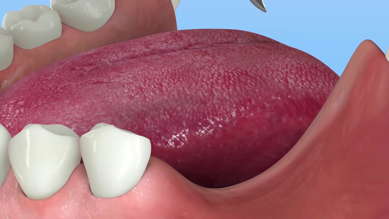 Geistlich Patient Information Major Bone Augmentation - YouTube