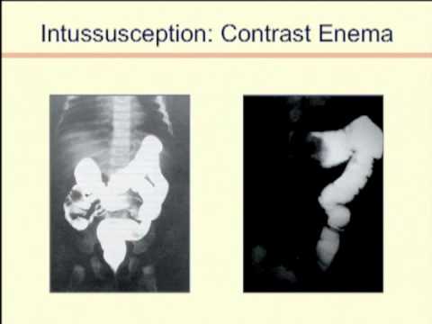 Intussusception Claw Sign