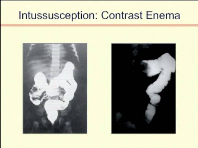 Intussusception Claw Sign Gastrointestinal Imaging | Radiology Key