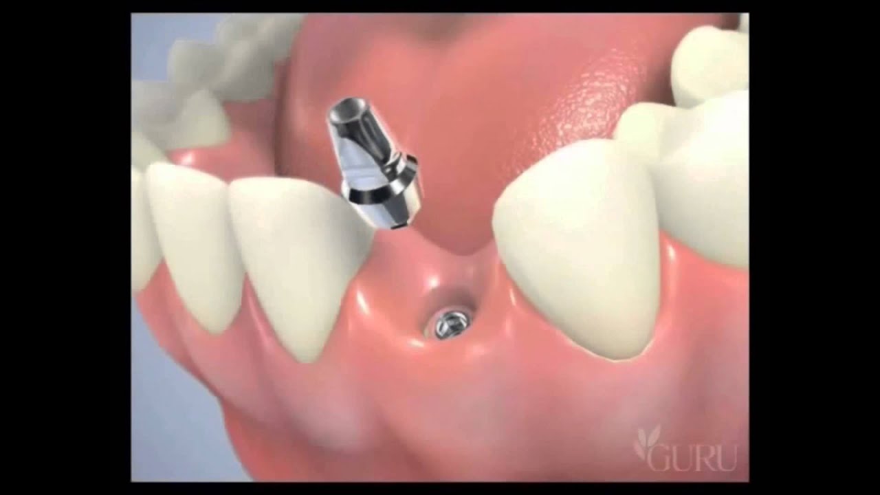 Demo Implante Unico - YouTube