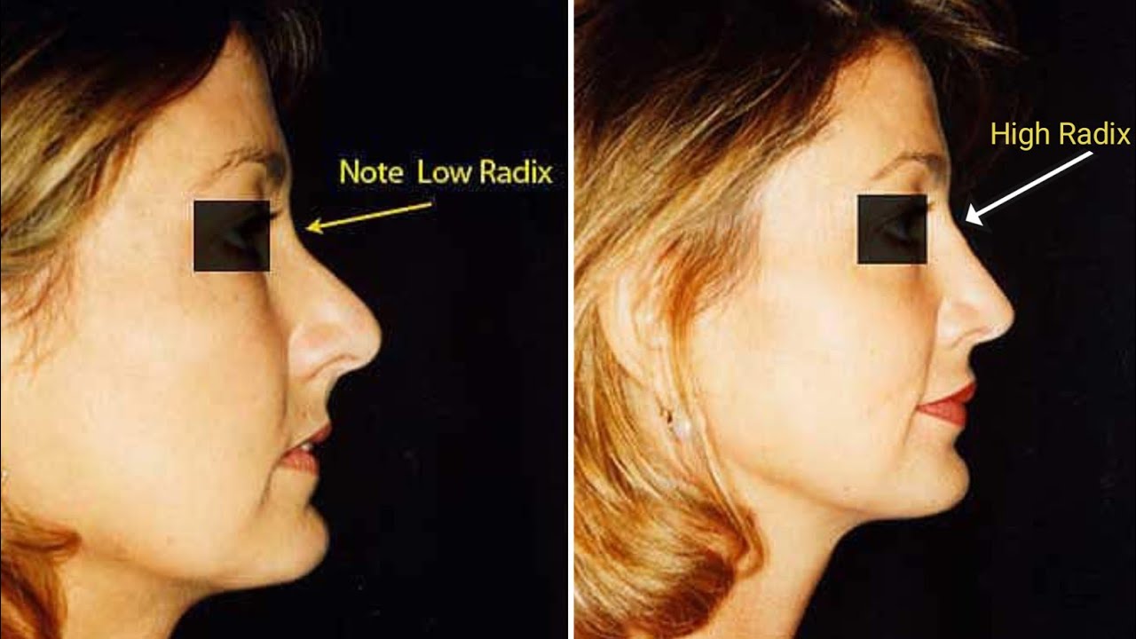 Why Your Side Profile Looks Weak (Radix Issue) - YouTube