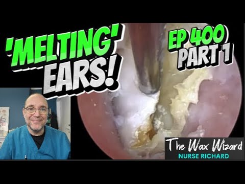 MELTING EARS! Part 1 Ep 400 #ear #earwax #earwaxremoval #asmr # ...