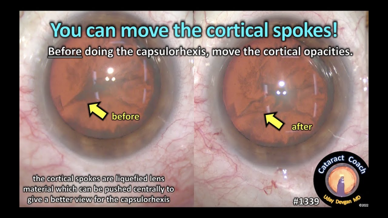 CataractCoach 1339: you can move cortical spokes - YouTube