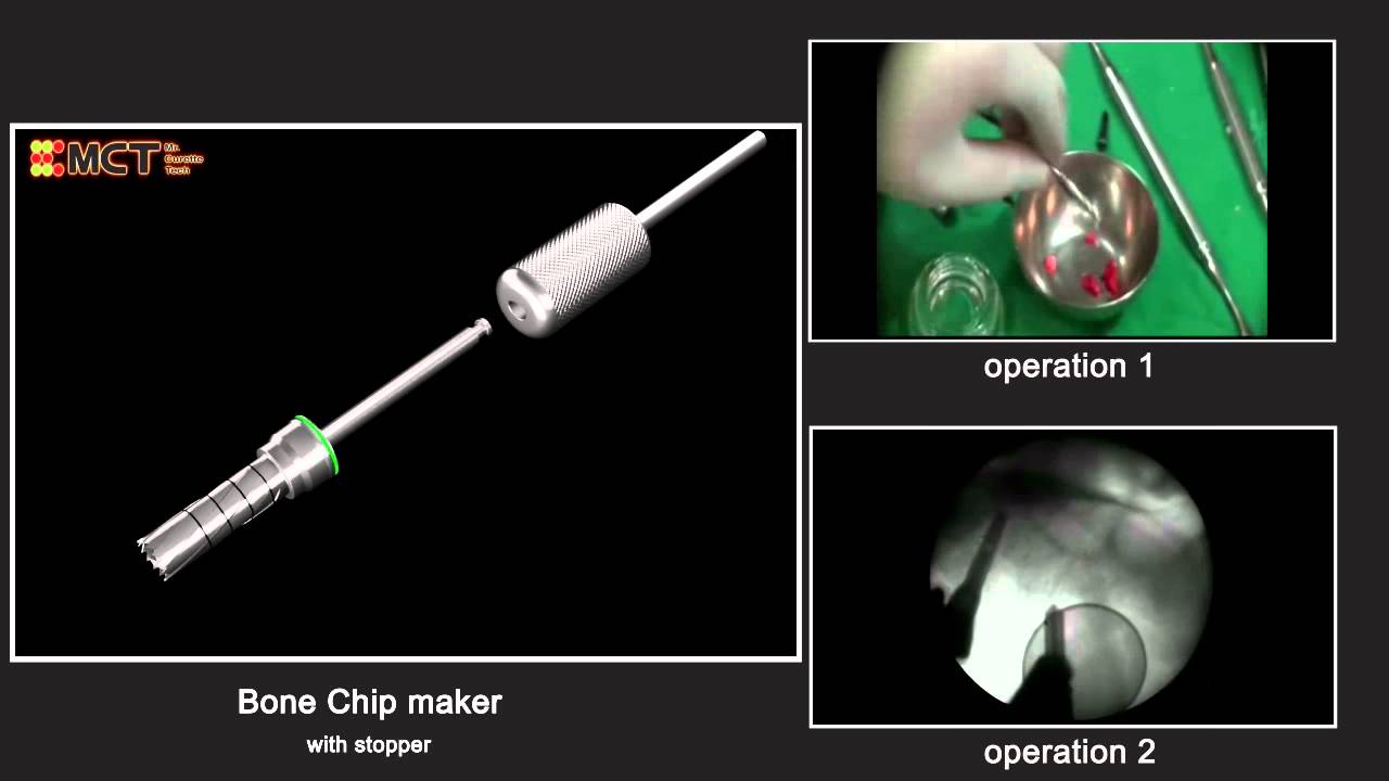 Bone Chip maker - YouTube
