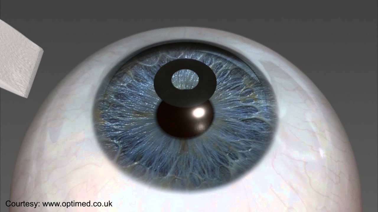 KAMRA Inlay Procedure Animation - Assil Eye Institute Los Angeles - YouTube