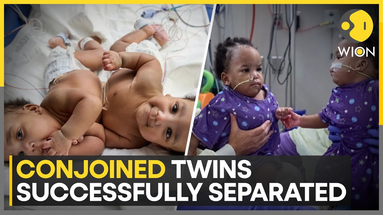 Conjoined Twins Successfully Separated After 8-Hour Long Surgery ...
