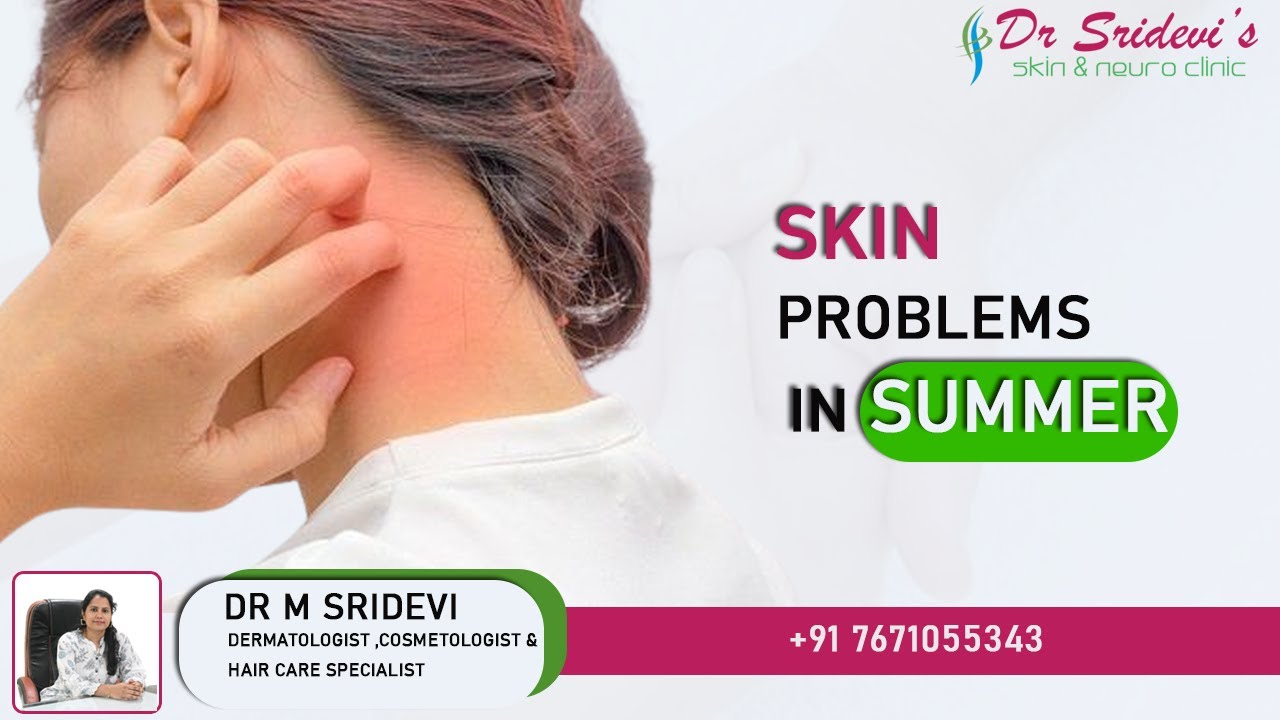 Skin Problems In Summer || Dr. Sridevi - Dermatologist - YouTube