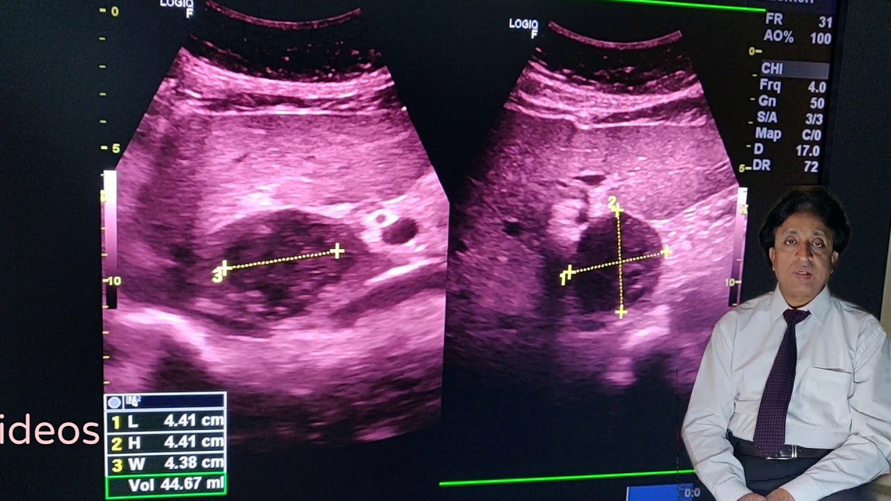 Caudate Lobe Of Liver Ultrasound